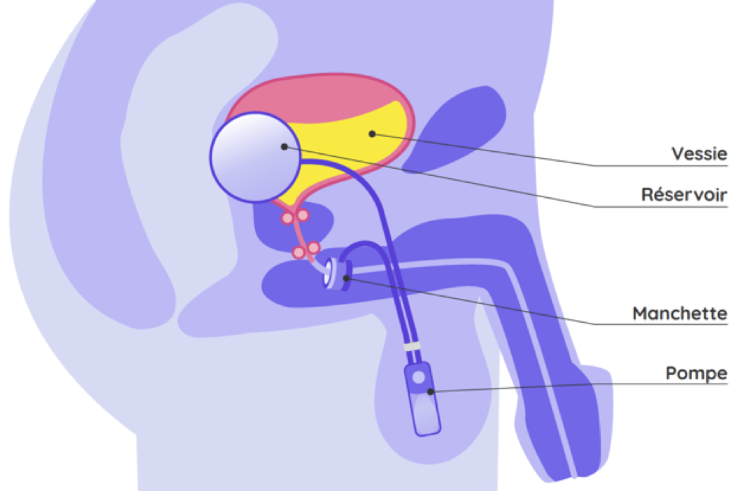 Urologie fonctionnelle et Neuro-urologie - Urologie CHU Lille