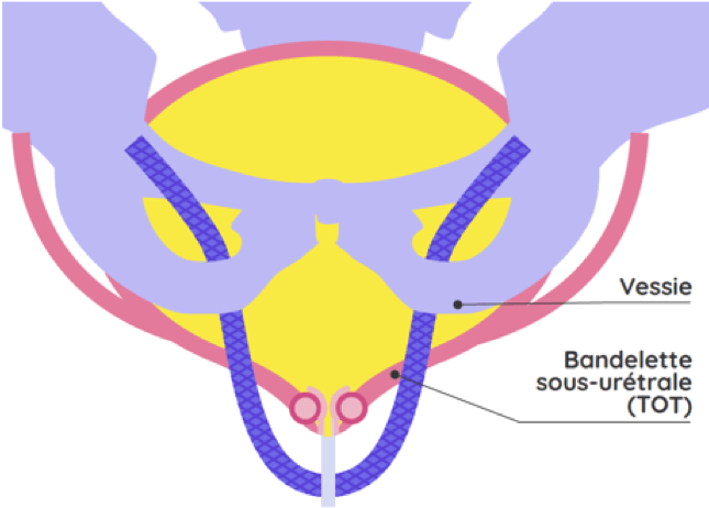 Urologie fonctionnelle et Neuro-urologie - Urologie CHU Lille