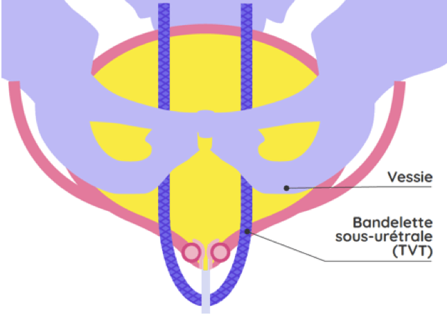 Urologie fonctionnelle et Neuro-urologie - Urologie CHU Lille